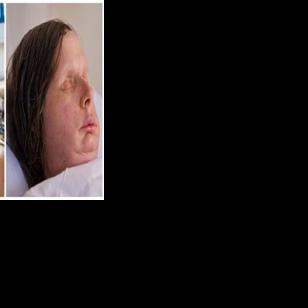 New face of chimpanzee attack victim revealed | News | annistonstar.com