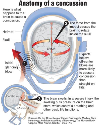 Football: Concussions are serious issue for the prep game, too | High ...