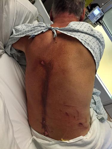 lightning strike on human