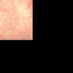 Houston health officials confirm city’s third case of measles this year ...