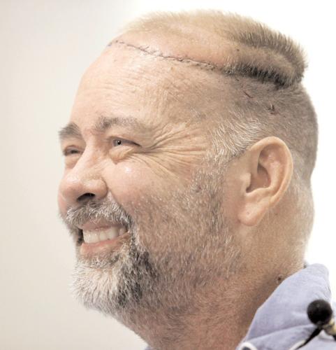 Texas doctors do world’s first skull-scalp transplant | Archives ...
