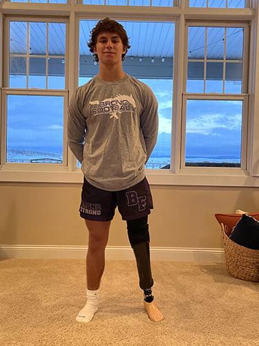 Prosthetic leg does not limit Broncs Logan Tyndall | Local Sports ...