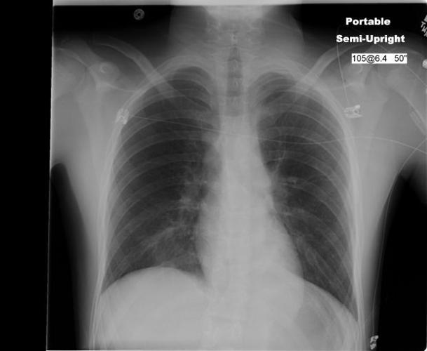 Senior puts pieces back together after accident