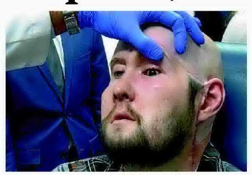 Man receives the first eye transplant, new face