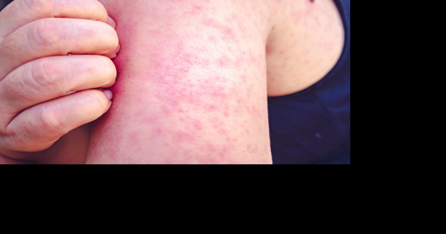Montana health officials confirm Flathead County measles case | News ...
