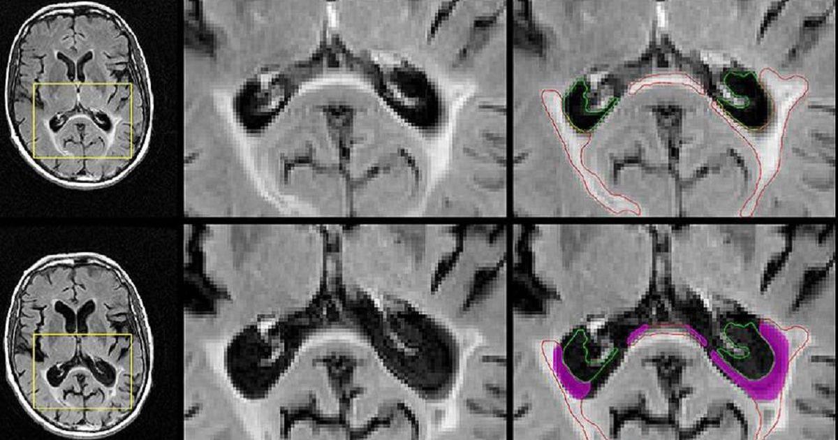 Story collection: Multiple sclerosis research and treatment in WNY