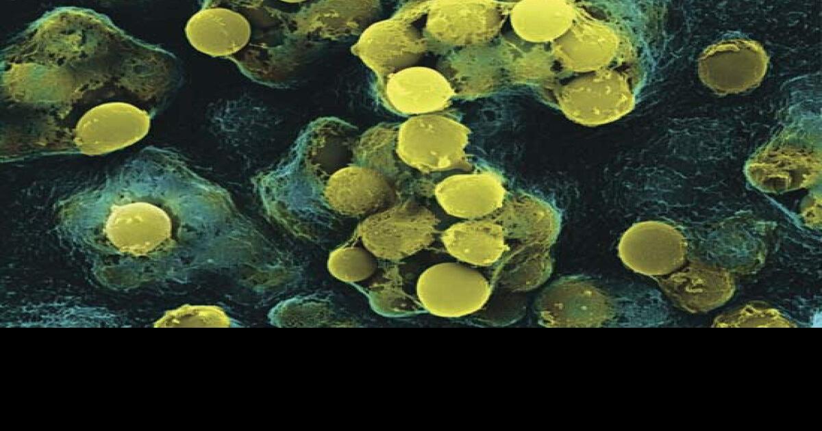 Invasive Group A Strep: Peel Region stats and what you need to know