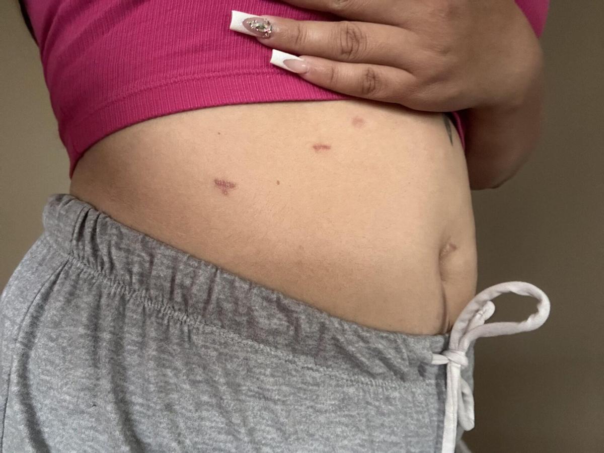 gallbladder operation scars