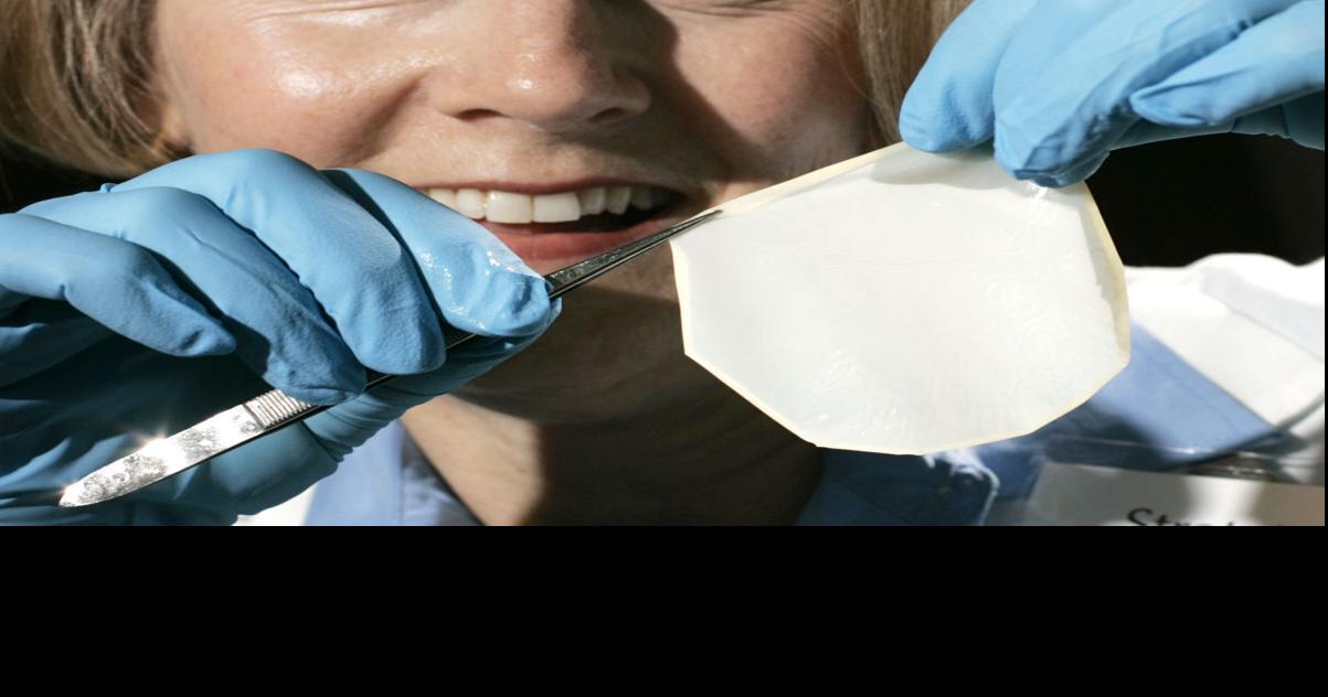 FDA approves Madison-based skin graft technology to treat burns ...