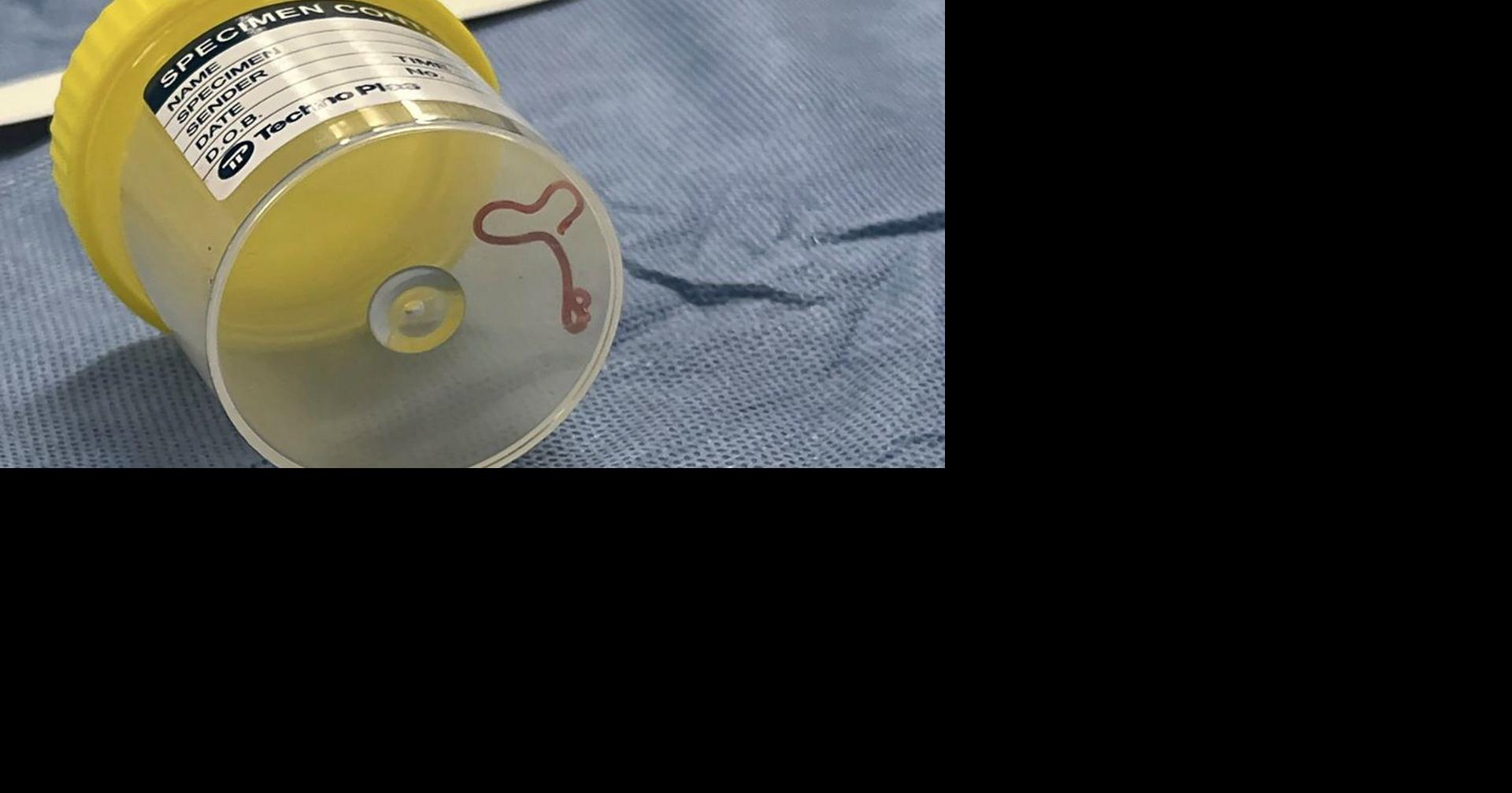 Doctors expected to find cancer in a woman's brain. They found a worm ...