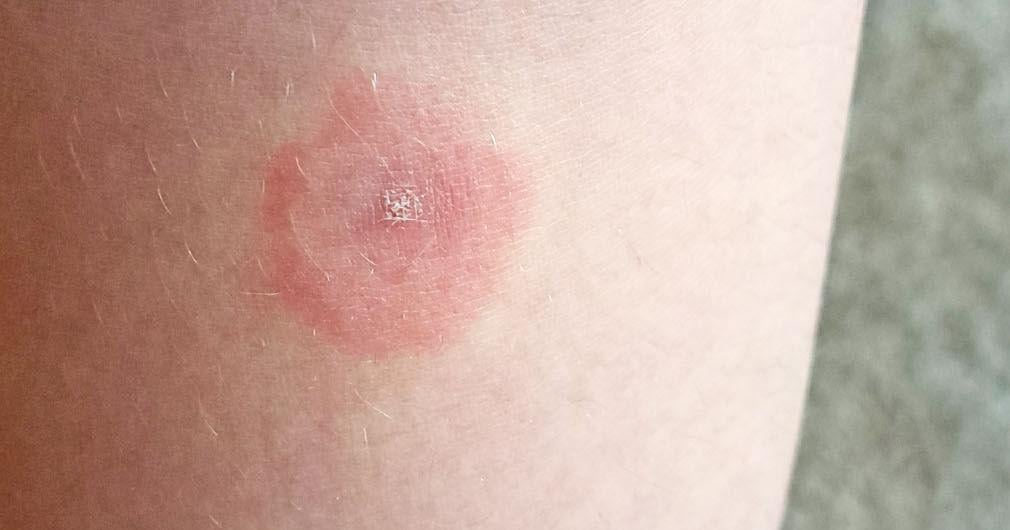 TASTE TRAVELER: Be aware of the dangers of ticks | Lifestyles ...