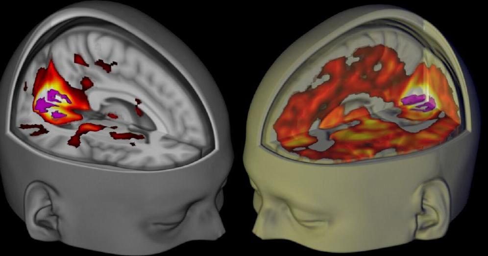 Groundbreaking images show how LSD literally lights up your brain ...