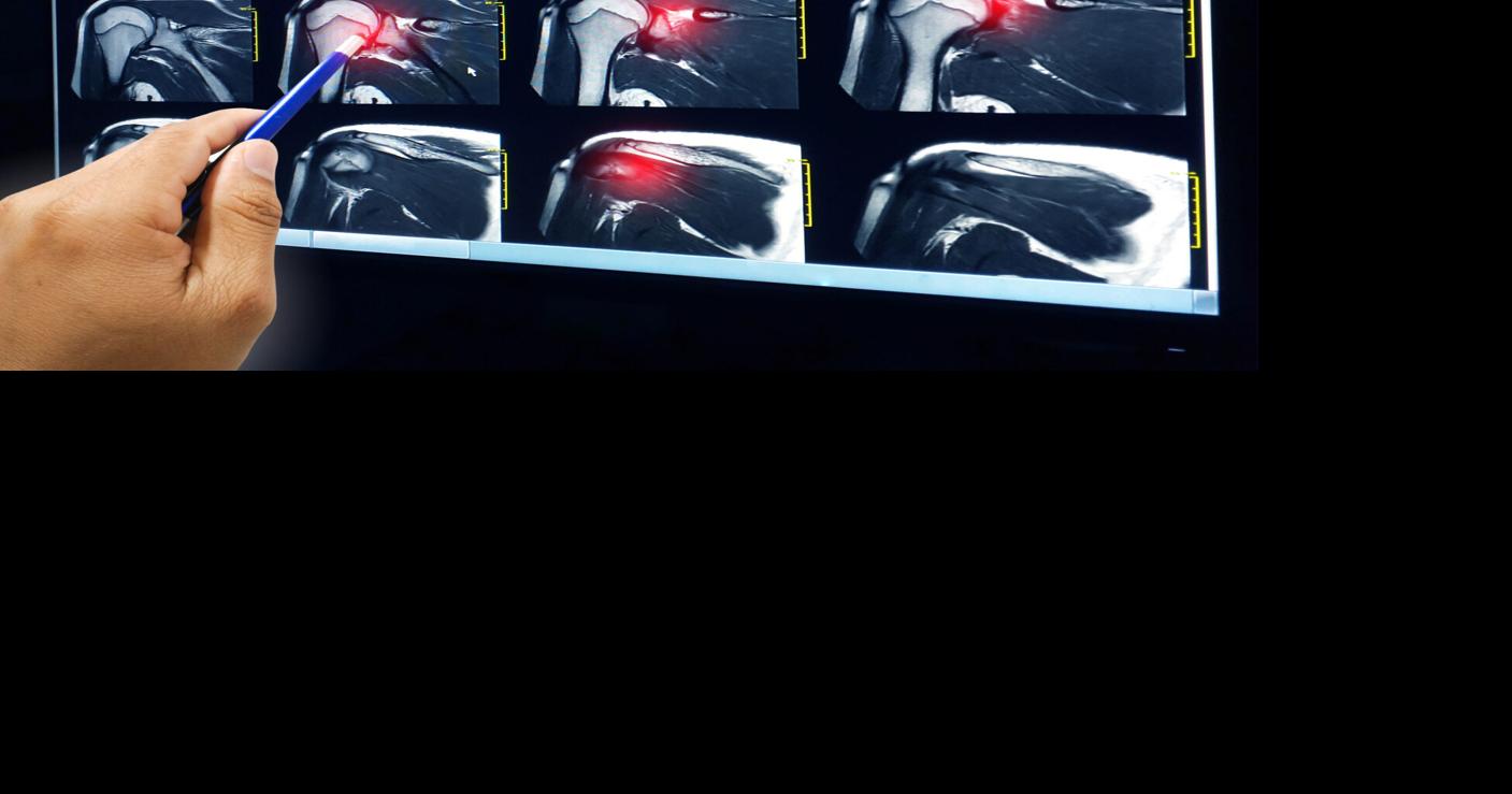Rotator cuff injuries are both painful and common