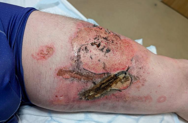 Man suffers serious burns to leg after vape battery explodes in pocket ...