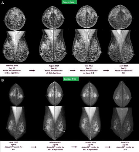 AI helps spot early warning signs of breast cancer sooner | Nation ...