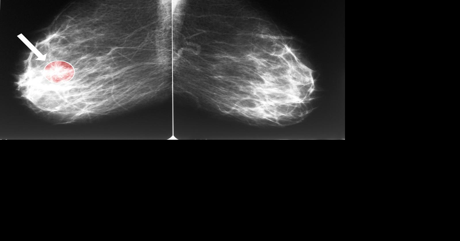 Study: Mammograms may reveal hidden heart risks for women