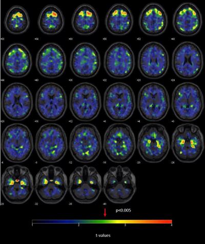 Brain scans may reveal concussion damage in living athletes
