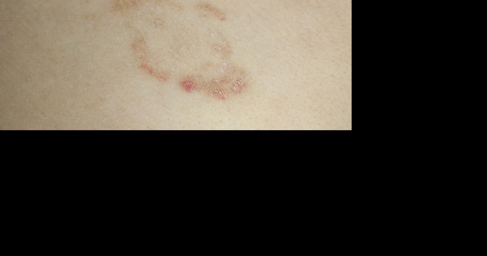 Ringworm: What to know and do | Health | dailyitem.com