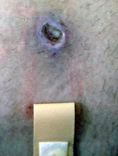 spider bite on thigh