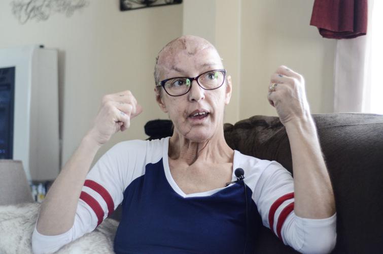 Bear attack victim recounts harrowing ordeal | Local News | dailyitem.com