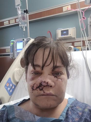 ‘We thought we’d die’: Brutal dog attack leaves lasting scars, sparks ...
