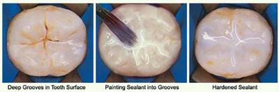 Dental sealants good way to prevent tooth decay | Features | dcourier.com