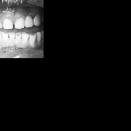 Grinding teeth can cause ‘craze lines’ and more | Features | dcourier.com