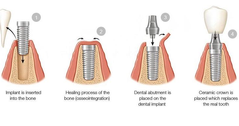 What are my options for missing or damaged teeth? | Features | dcourier.com