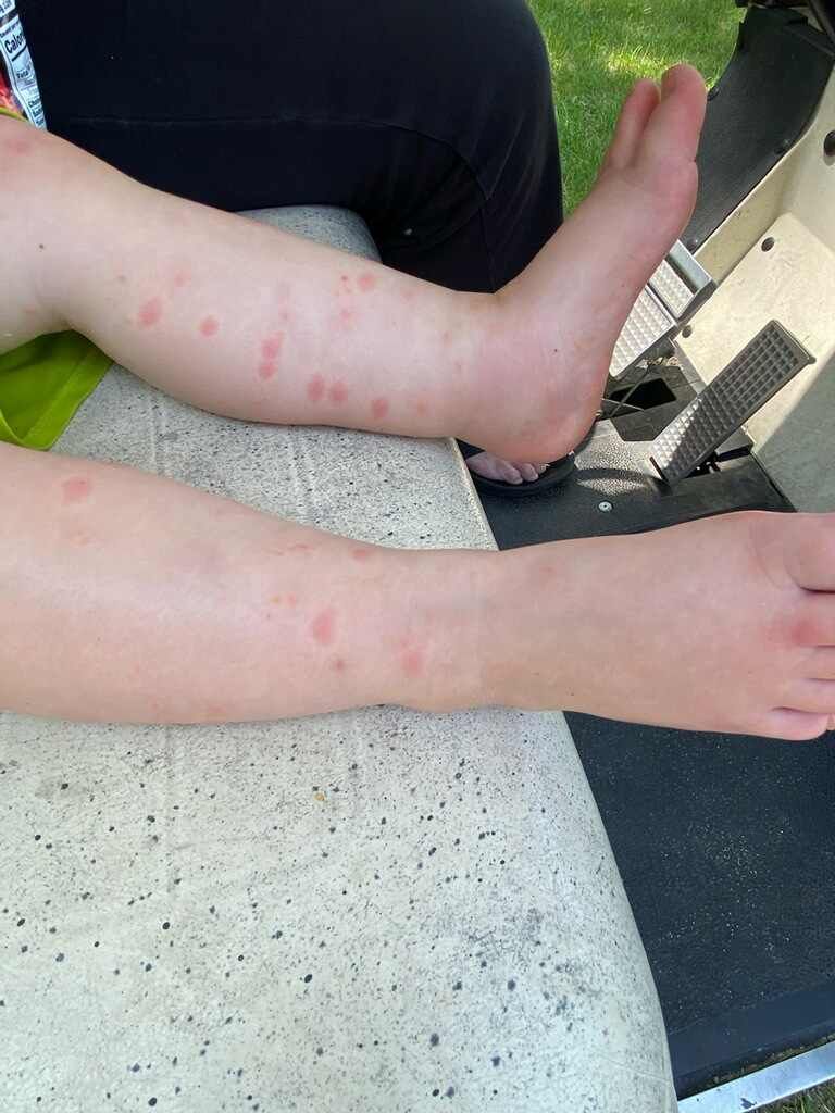 Feeling itchy?: Swimmer's itch season | News | fergusfallsjournal.com