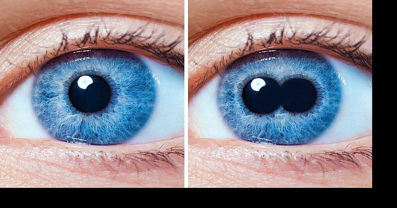 Two Pupils in One Eye And Other Strange Body Oddities | Videos ...