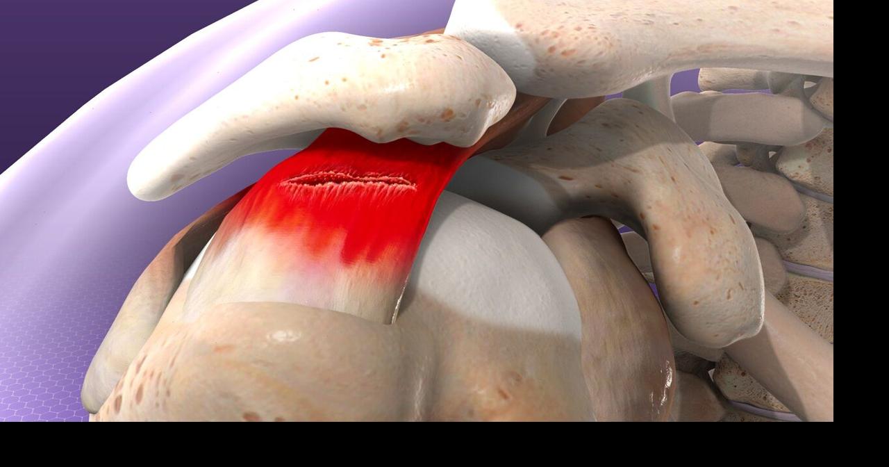 Rotator Cuff Injuries – One of the Most Aggravating and Painful ...