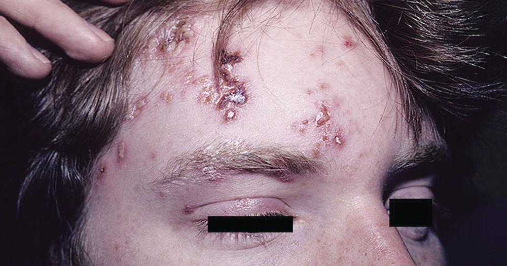shingles on forehead causes