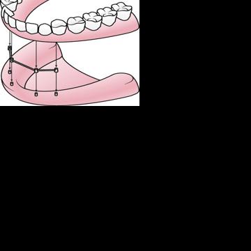 Implant-retained dentures: A solution for those with lower ridge resorption
