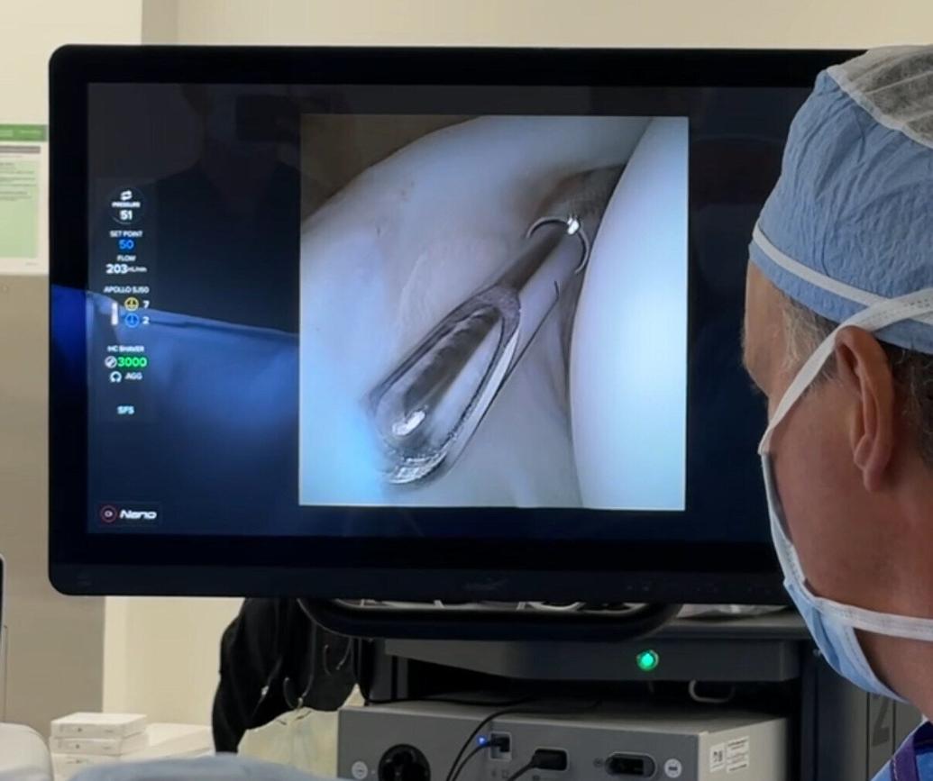 Arthrex debuts NanoNeedle scope 2.0 with first clinical use | GB Daily ...