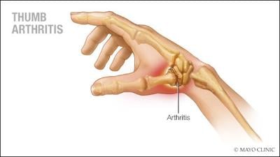 Mayo Clinic Minute: Reducing thumb arthritis pain | Lifestyle ...