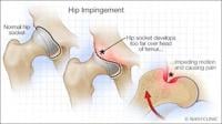 Mayo Clinic Q&A: How is hip impingement affecting young adults ...