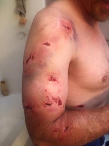 drop bear attack wounds