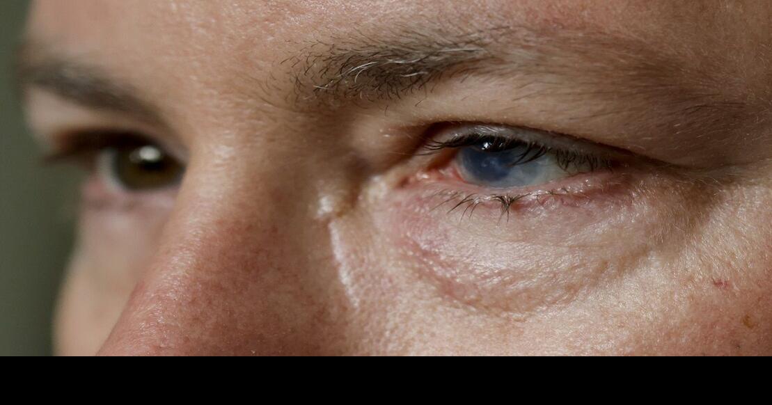 Promising stem cell treatment restores vision in one eye