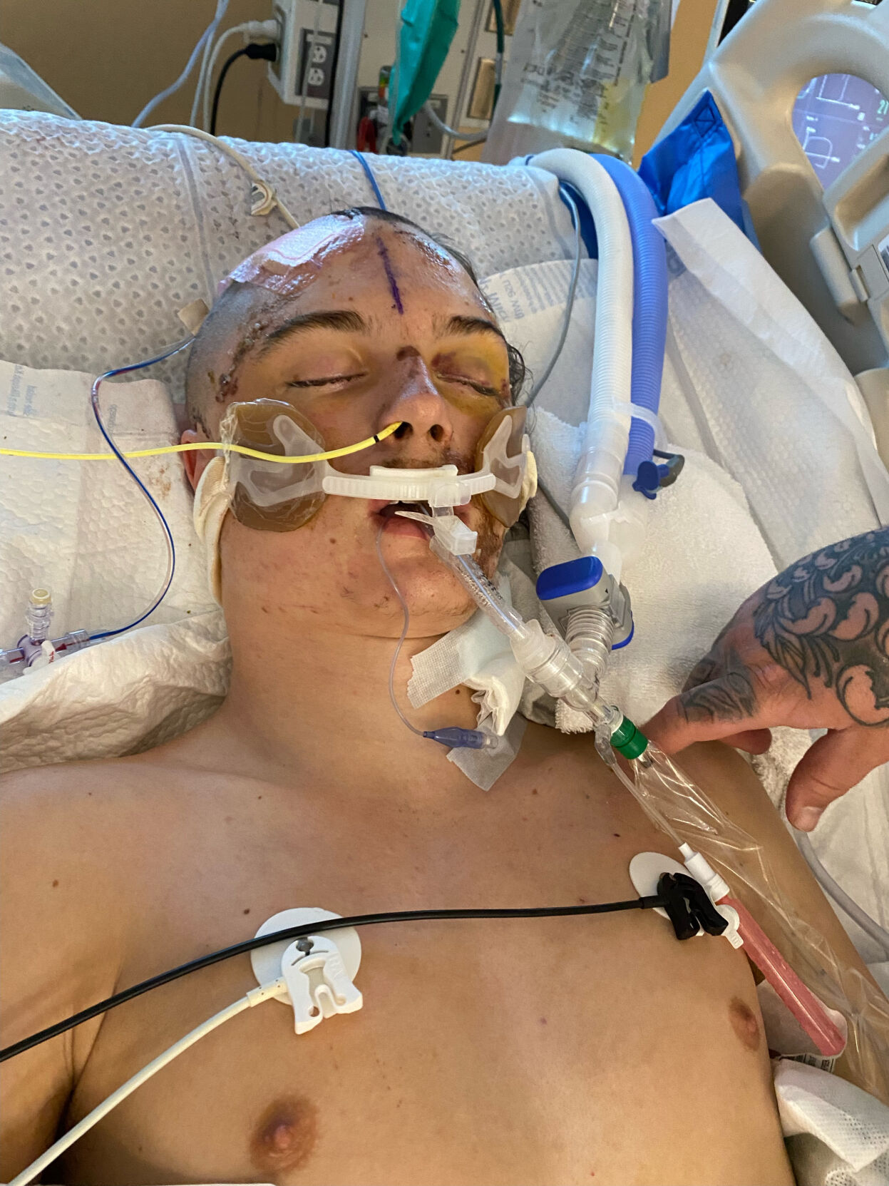 Logan High student suffers severe brain injury after being hit by truck ...