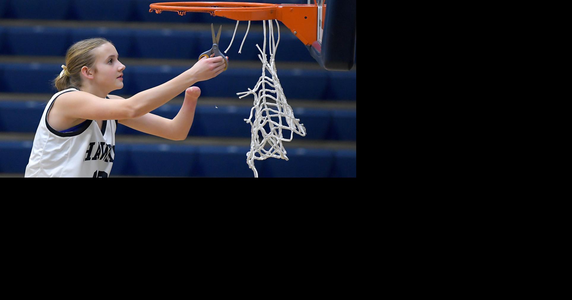 Addition by subtraction: Girl born with underdeveloped hand continues ...