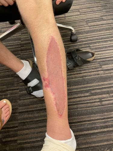 Amie Just: The story behind Peyton Robb's gnarly leg scars shows ...