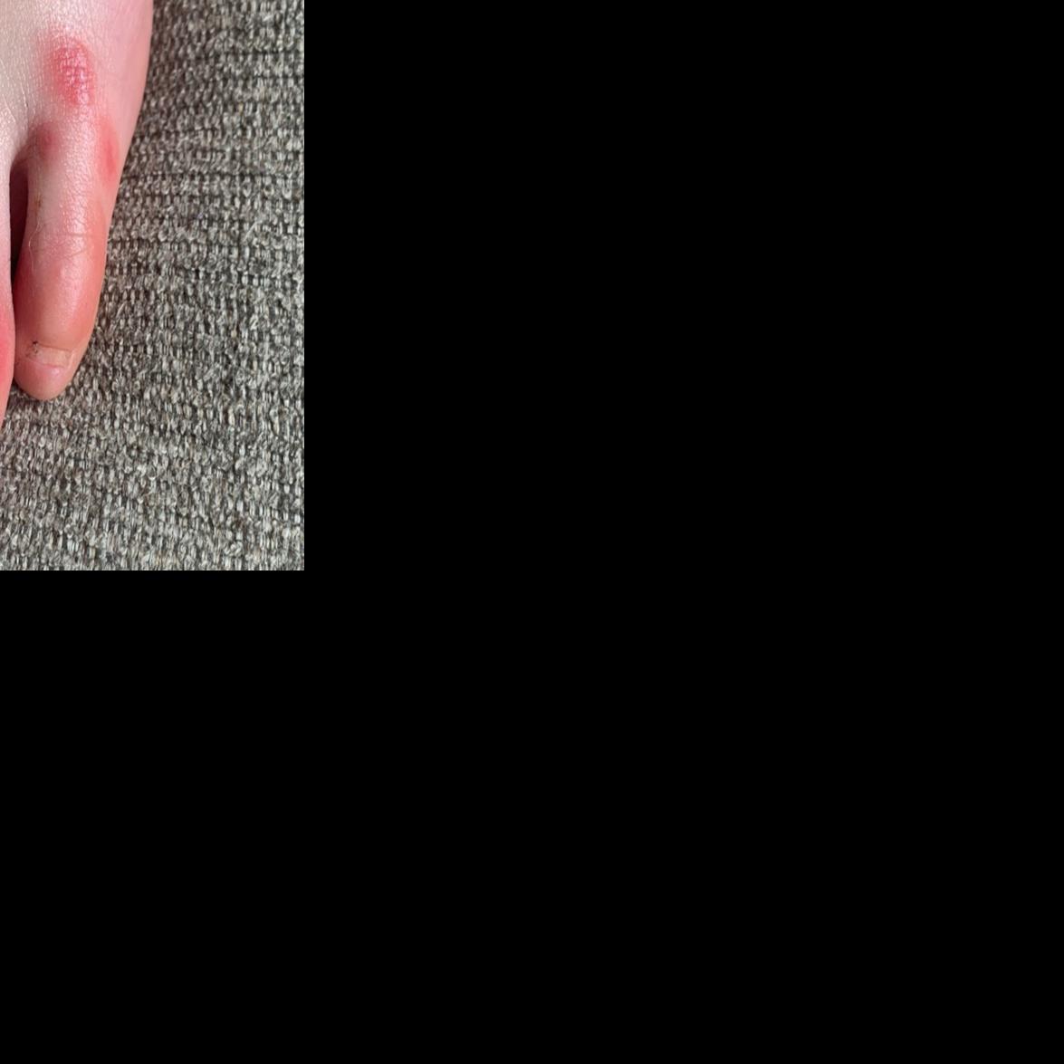 'COVID toes,' other rashes latest possible rare virus signs | Health ...