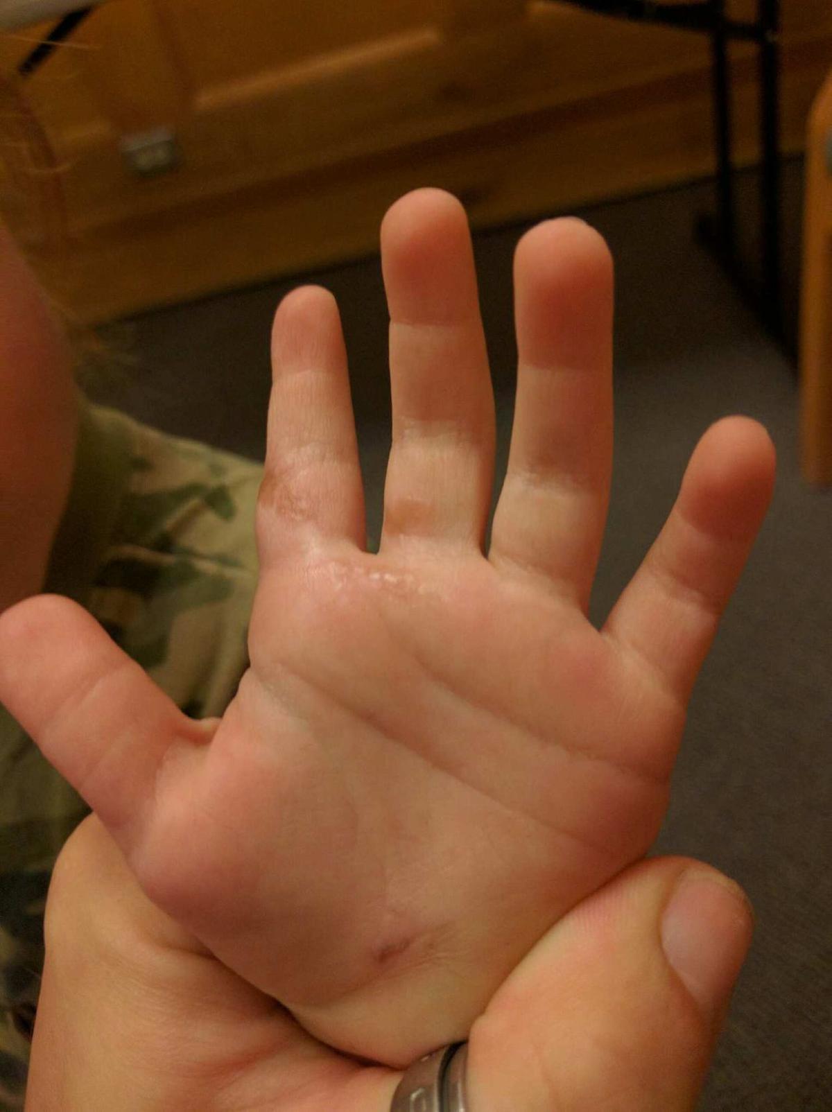 Pocatello mom urges others to be careful after her child burns hand on ...