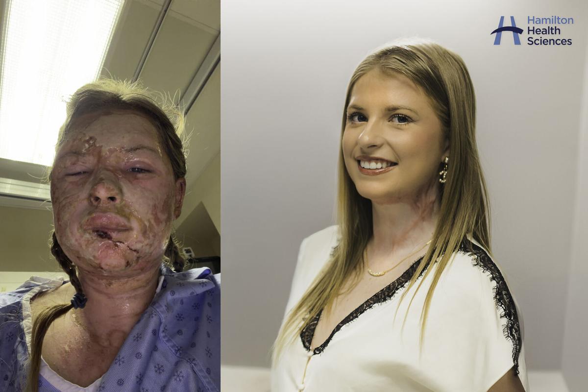 Young Ontario woman receives ‘world-first’ burn treatment