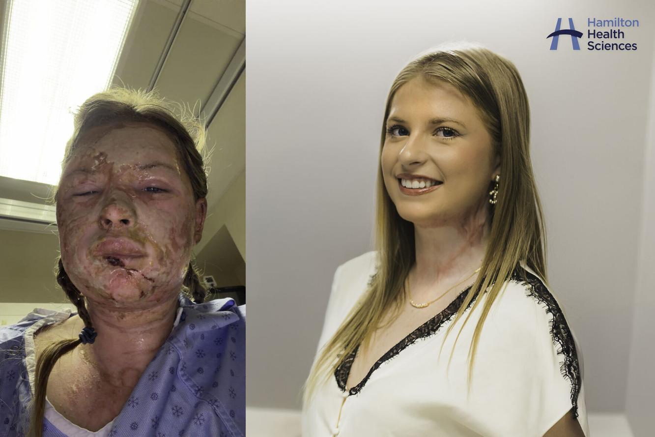 Young Ontario woman receives ‘world-first’ burn treatment