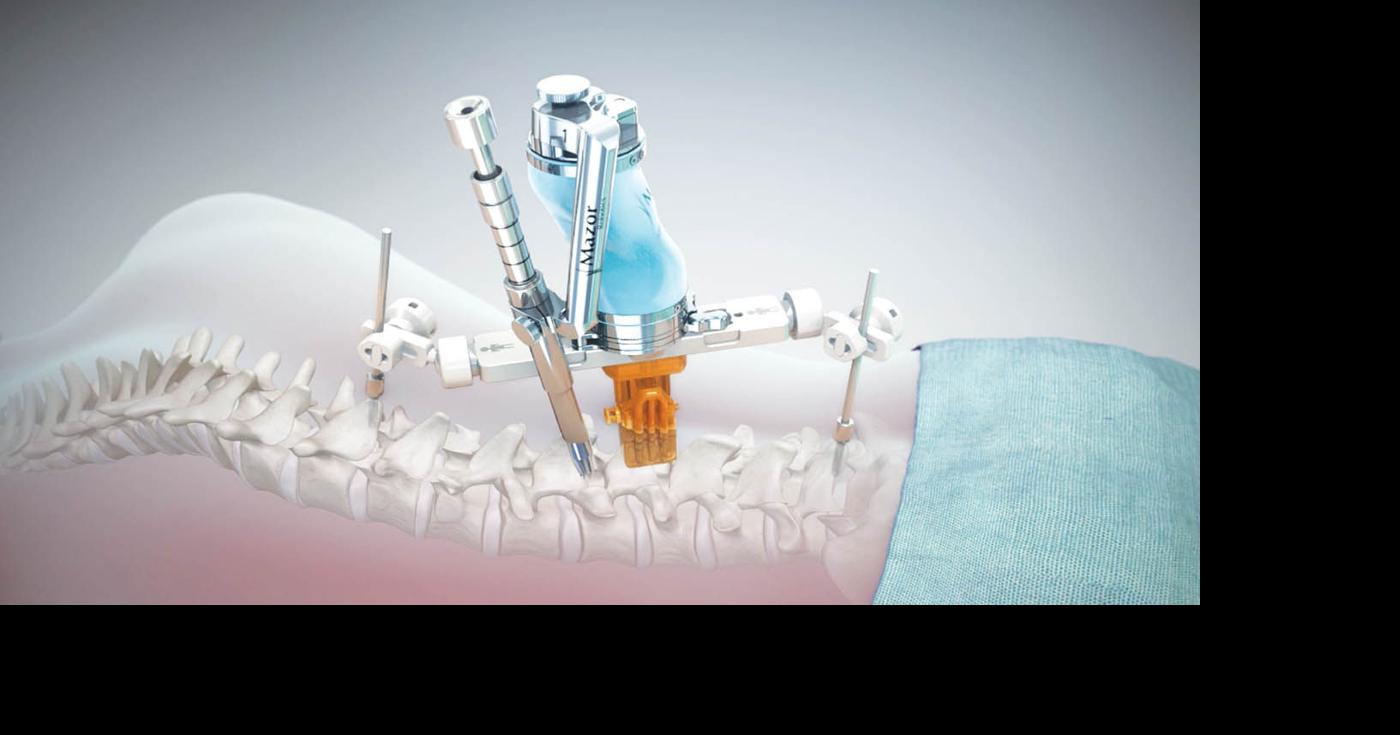 ETMC Tyler offers new robotics guidance system for scoliosis surgery ...