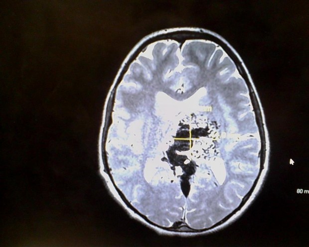 Chloe's story: 14-year-old doesn't let rare brain condition hinder her ...