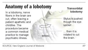 Lobotomy back in spotlight