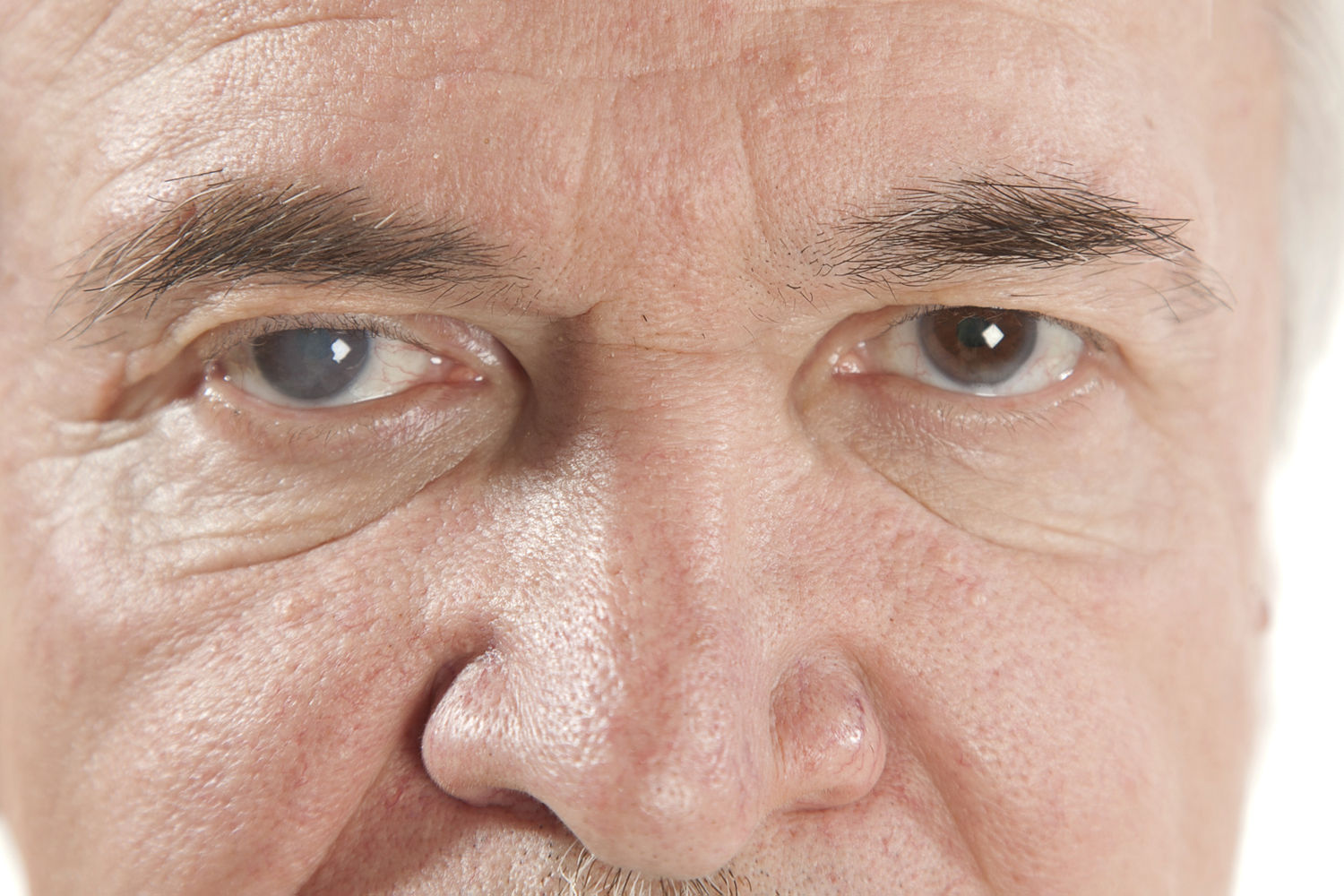 Curing Cataracts Without Surgery Curing Cataracts Without Surgery