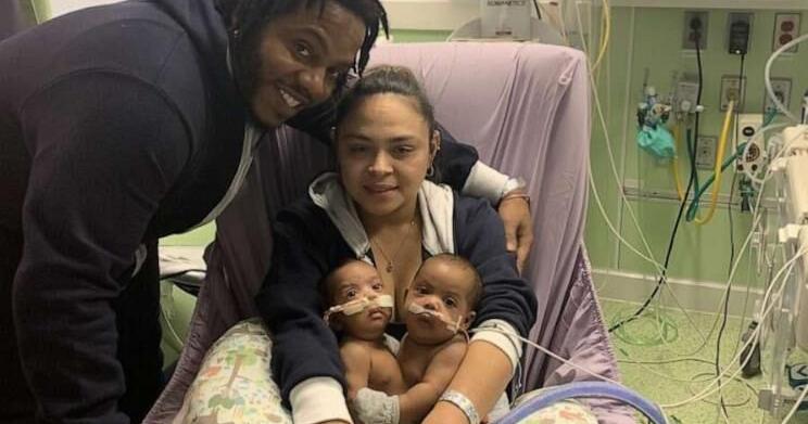 Formerly conjoined twin sisters turn 1, take first steps in major ...
